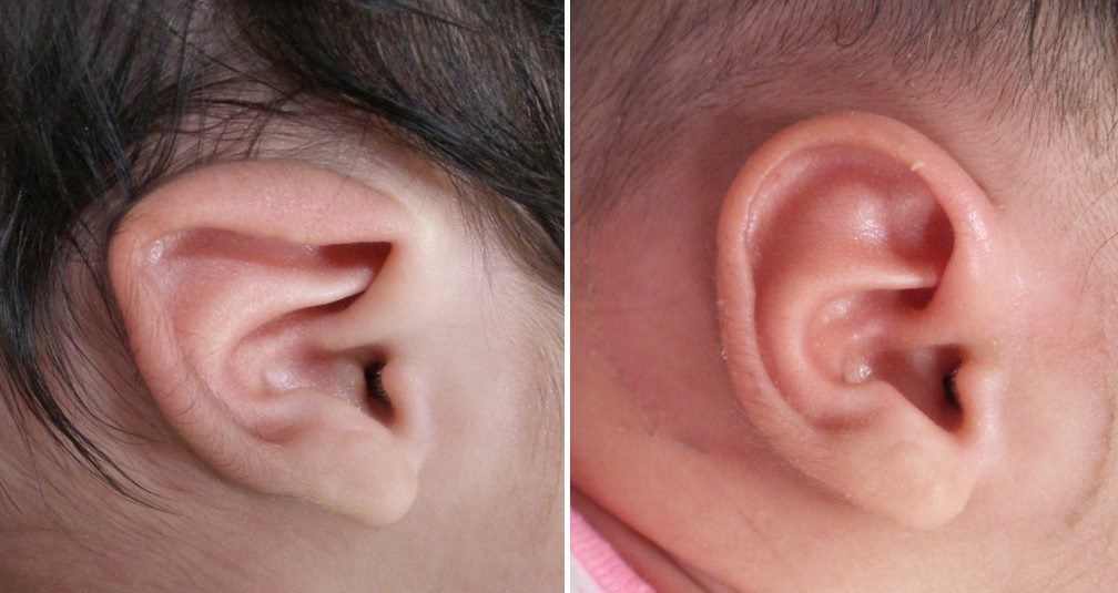 Ear Molding & Infants: What You Need to Know - Greenwich Moms