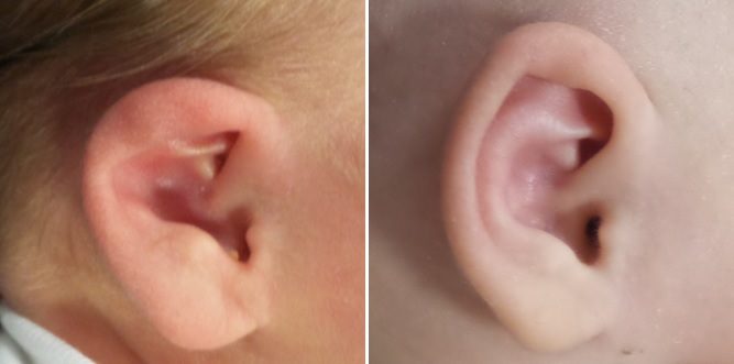 Ear Molding & Infants: What You Need to Know - Greenwich Moms